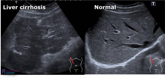 Abdominal Ultrasound